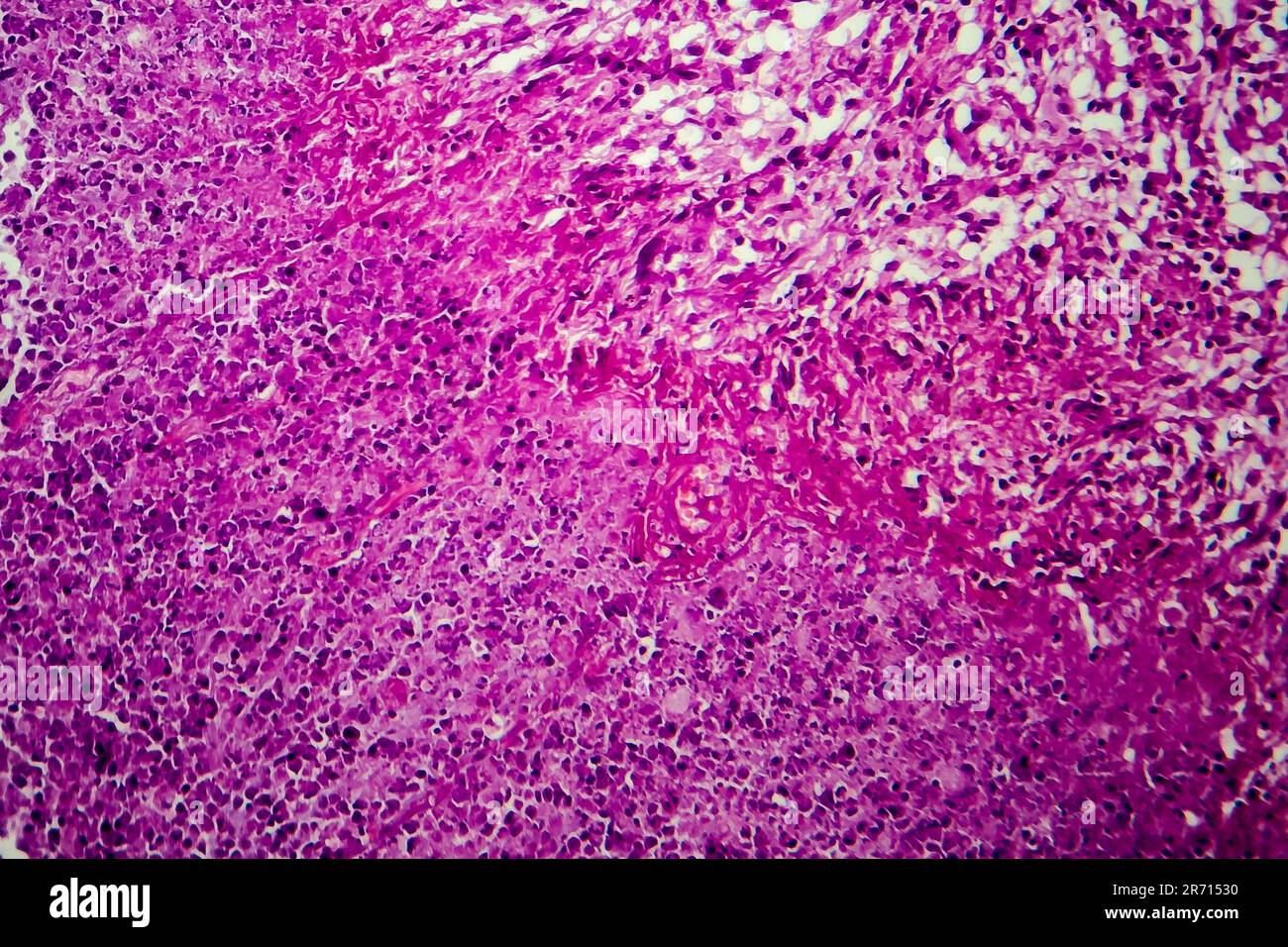 Caseation of human tuberculosis granuloma, light micrograph, photo ...