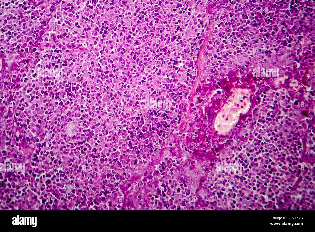 Caseation of human tuberculosis granuloma, light micrograph, photo ...