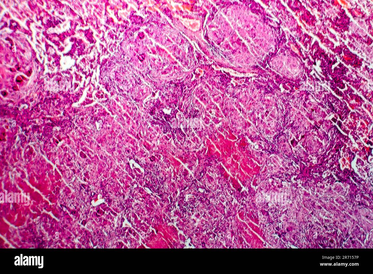 Miliary tuberculosis, light micrograph, photo under microscope Stock ...