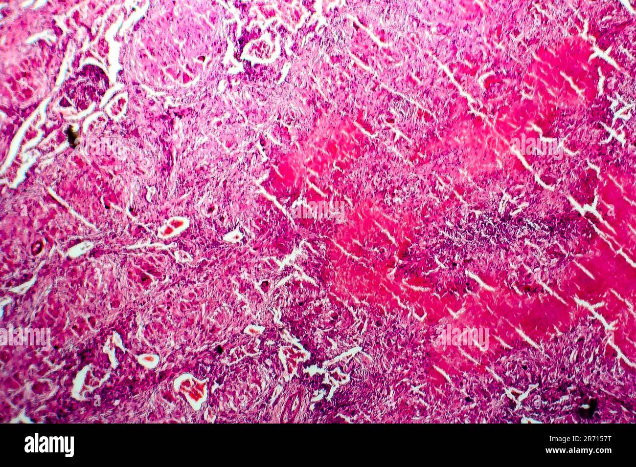 Miliary Tuberculosis Histology