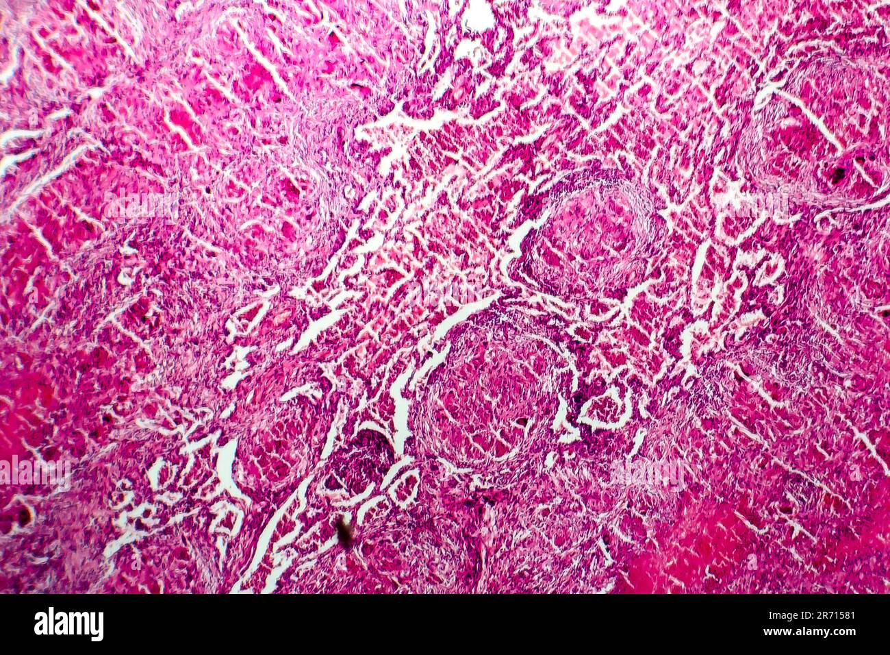 Miliary tuberculosis, light micrograph, photo under microscope Stock ...