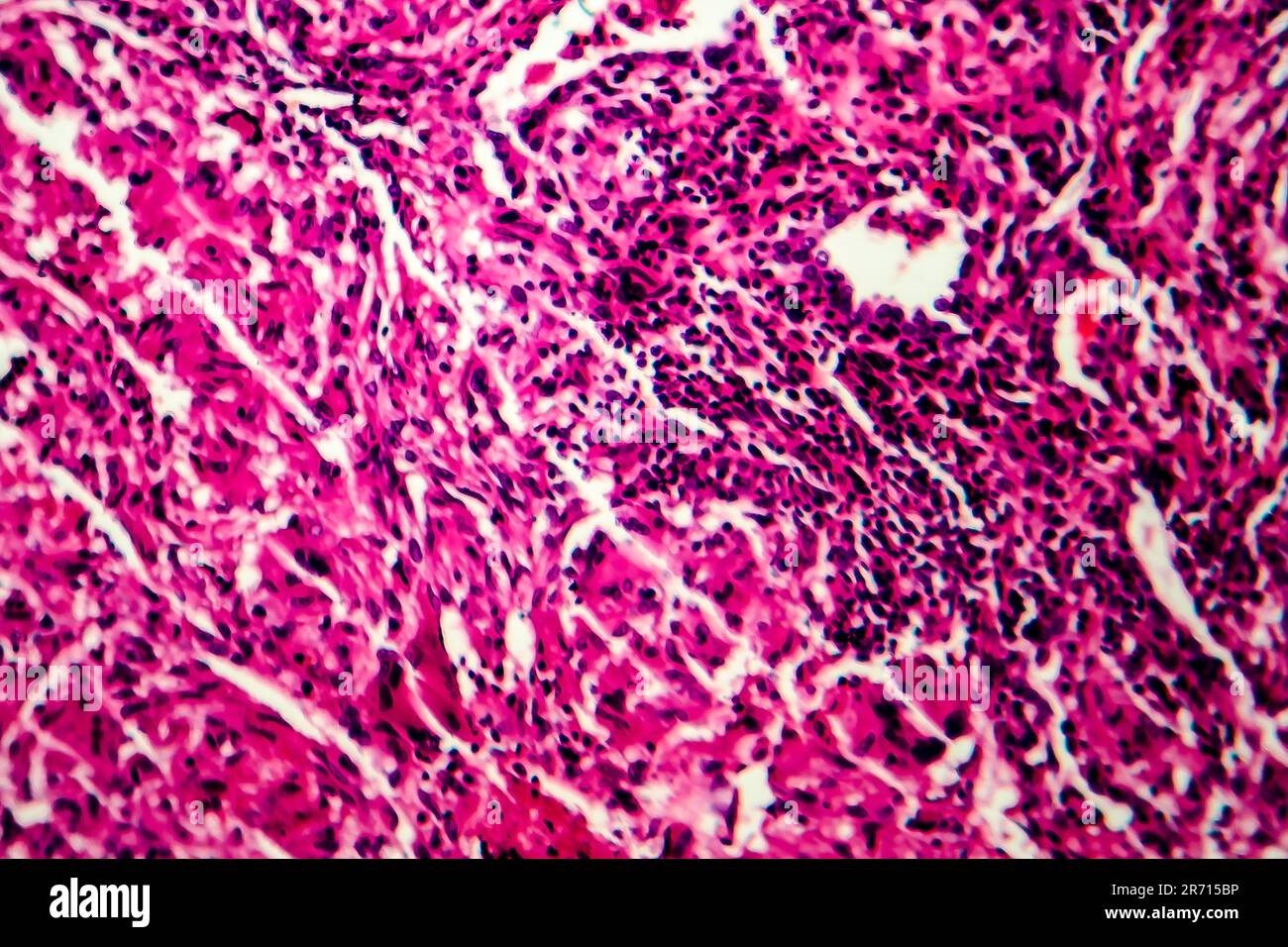 Miliary tuberculosis, light micrograph, photo under microscope Stock ...