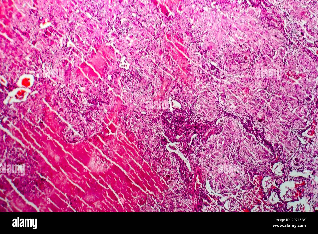 Miliary tuberculosis, light micrograph, photo under microscope Stock ...