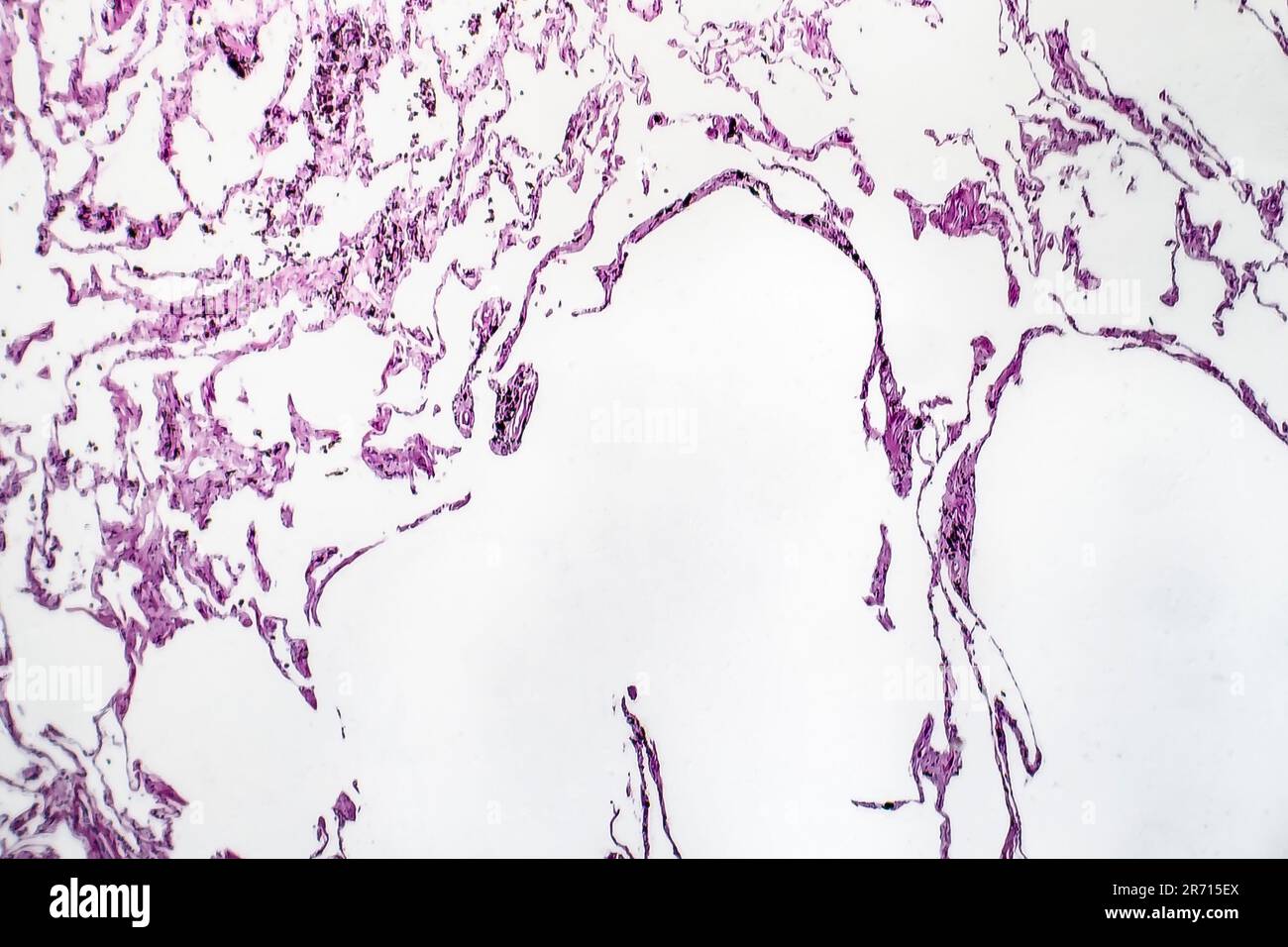 Emphysema Histology Comparison Pathology Outlines Emphysema