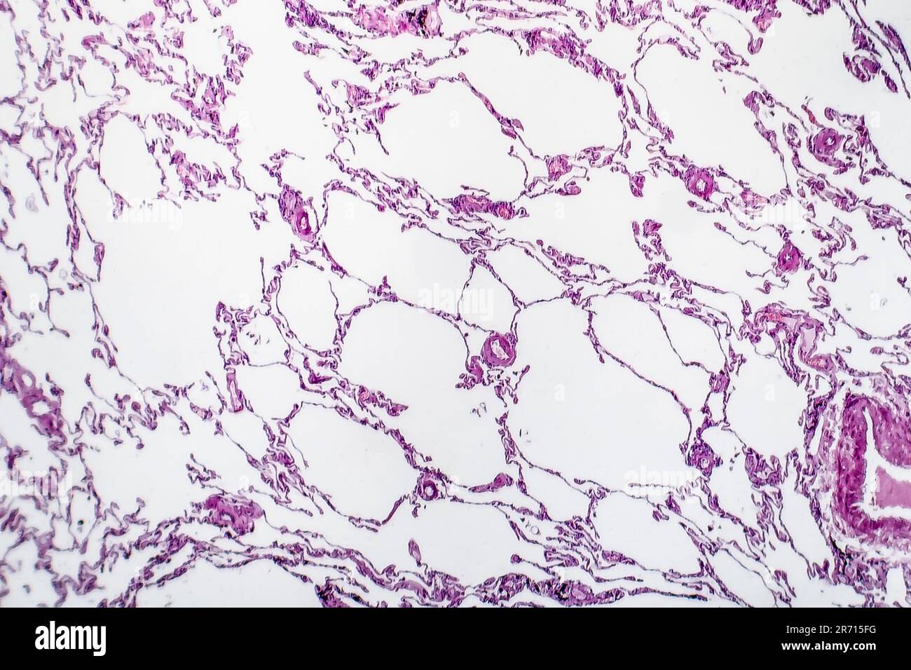 Emphysema Slide Labeled