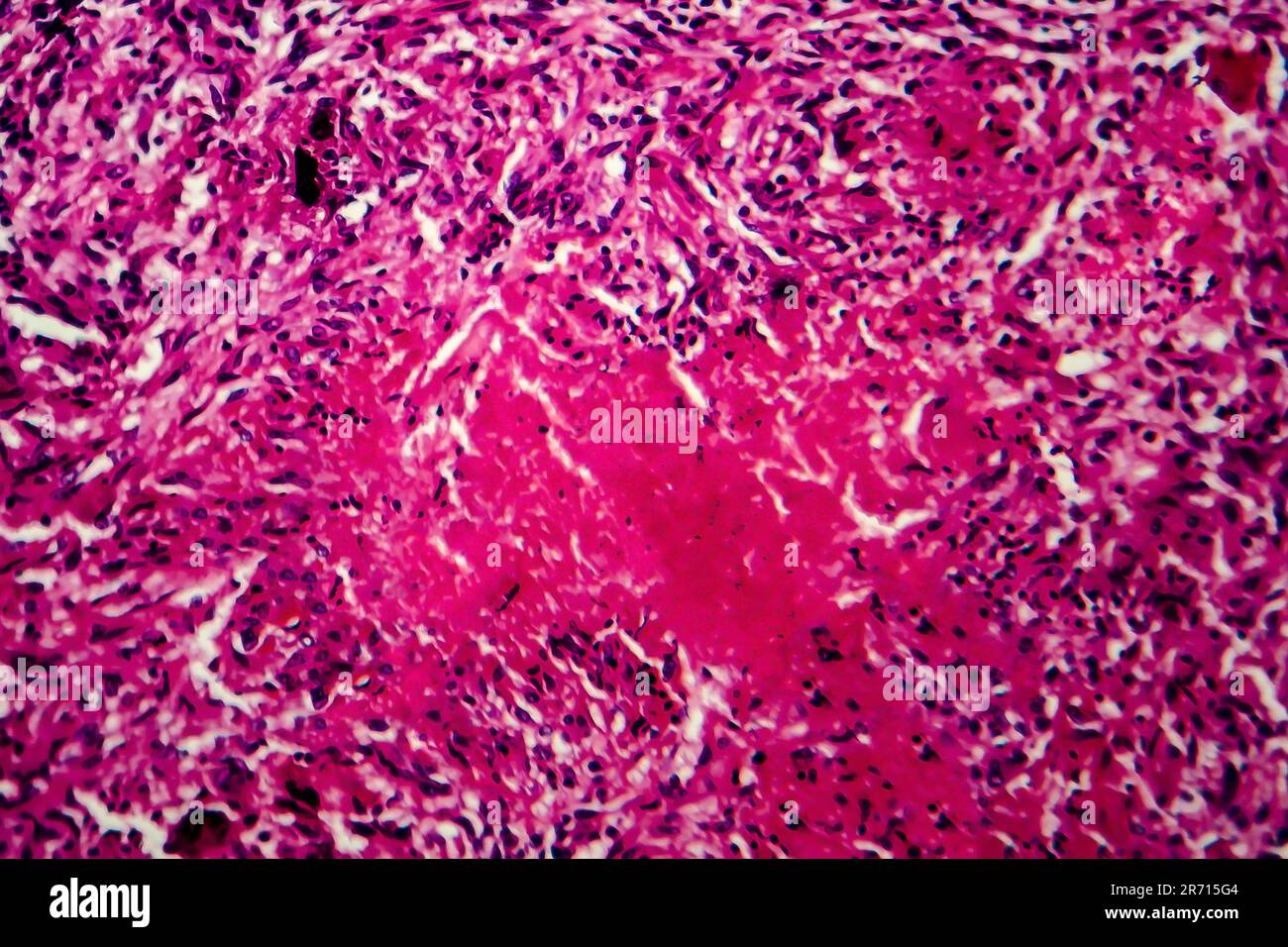 Miliary tuberculosis, light micrograph, photo under microscope Stock ...