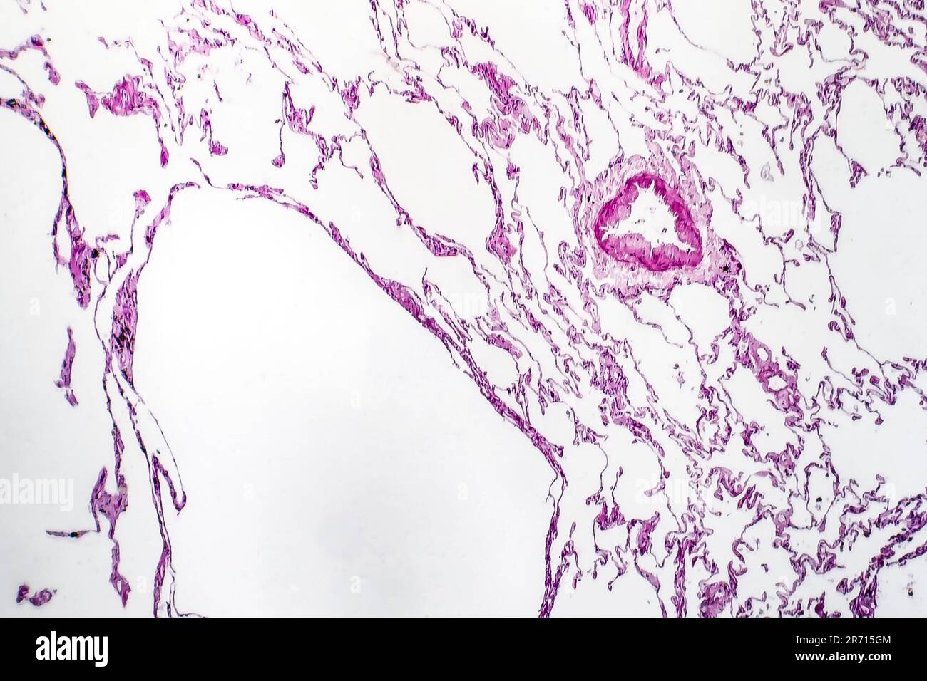 Emphysema Histology Labeled
