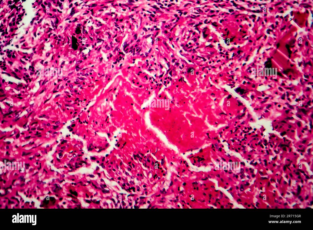 Miliary tuberculosis, light micrograph, photo under microscope Stock ...