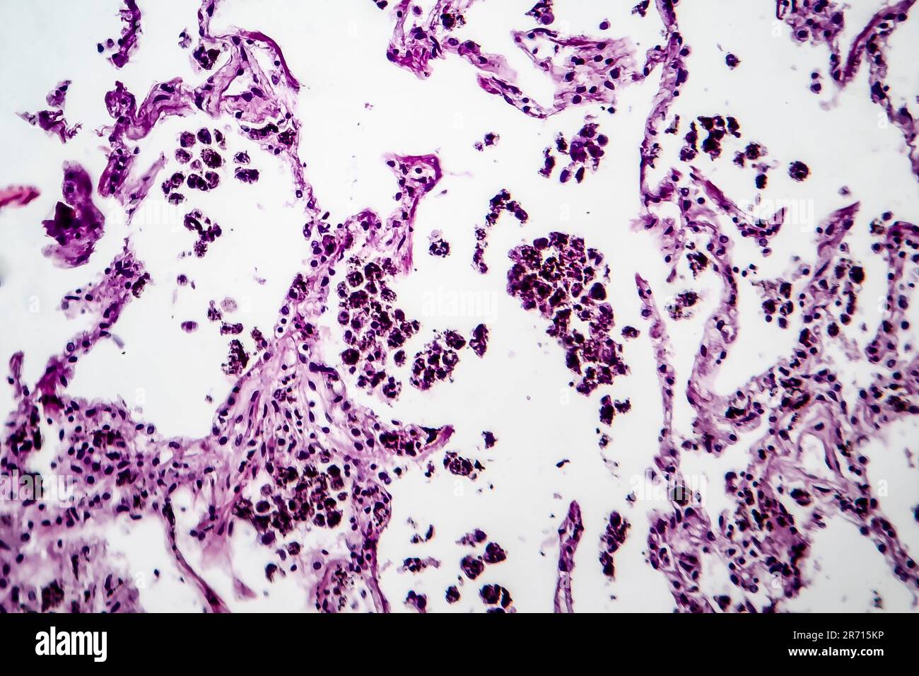 Histopathology of lung emphysema, light micrograph, photo under ...