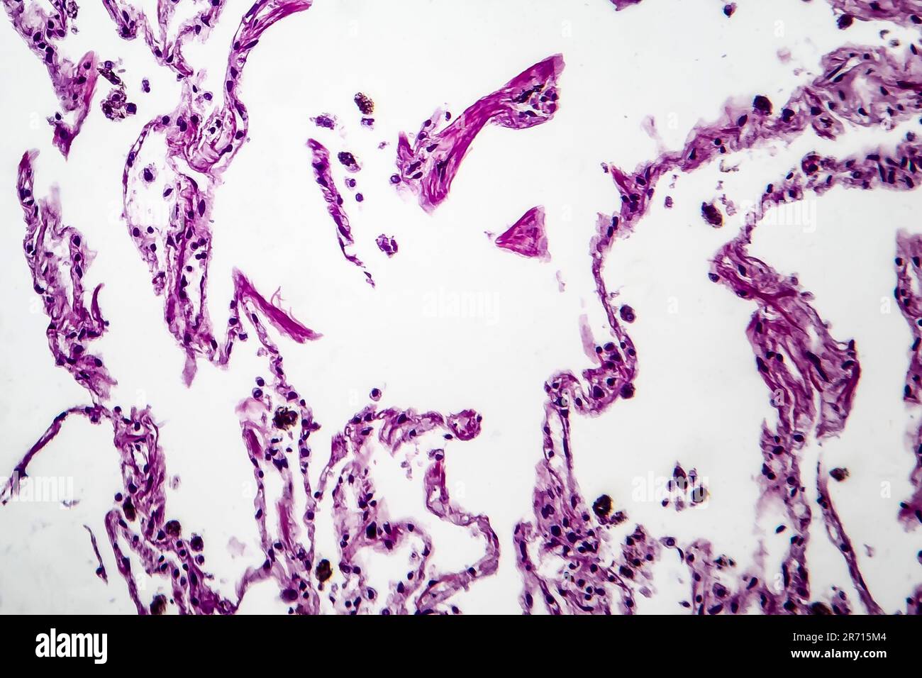 Emphysema Histology