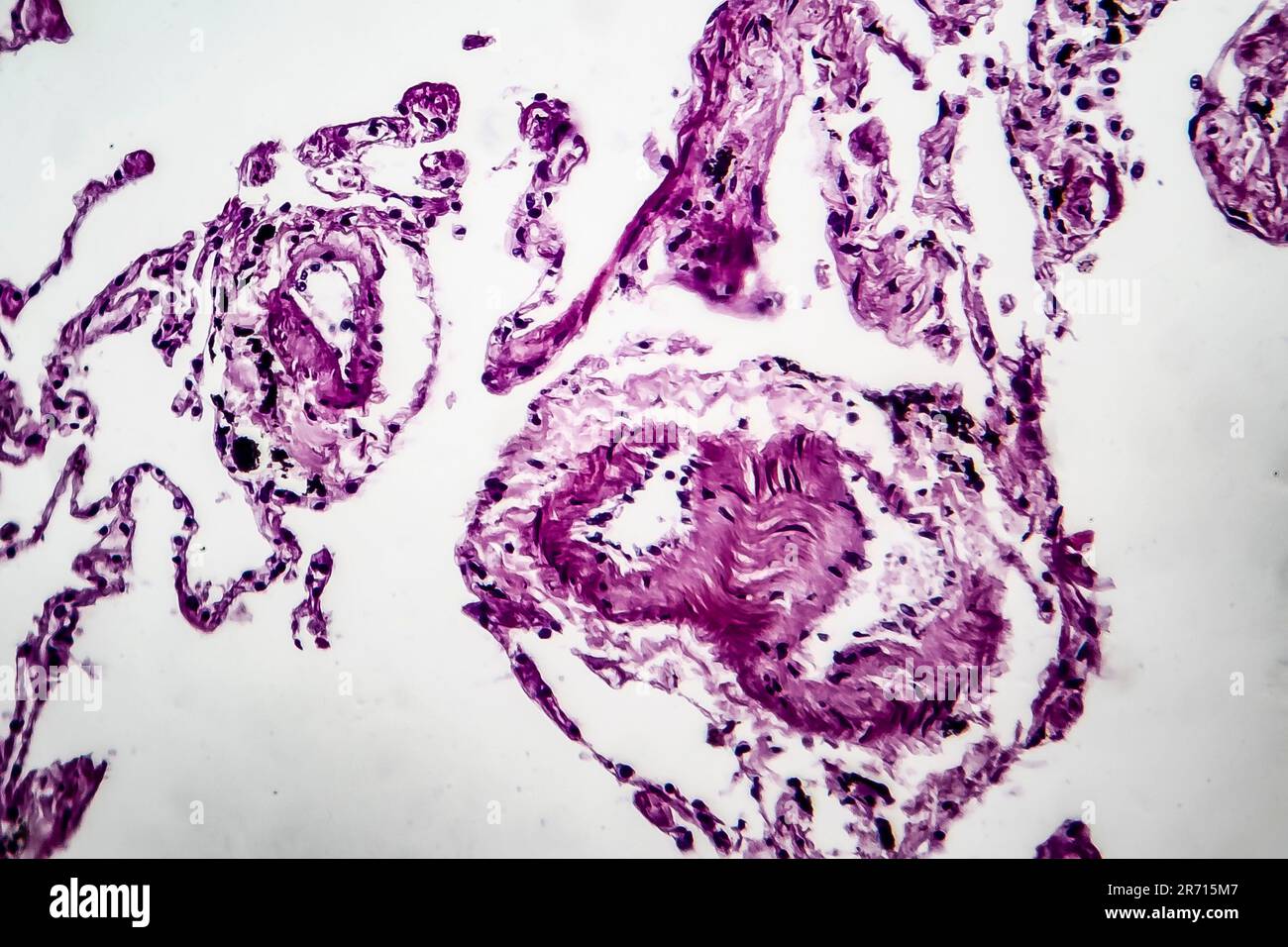 Histopathology of lung emphysema, light micrograph, photo under ...