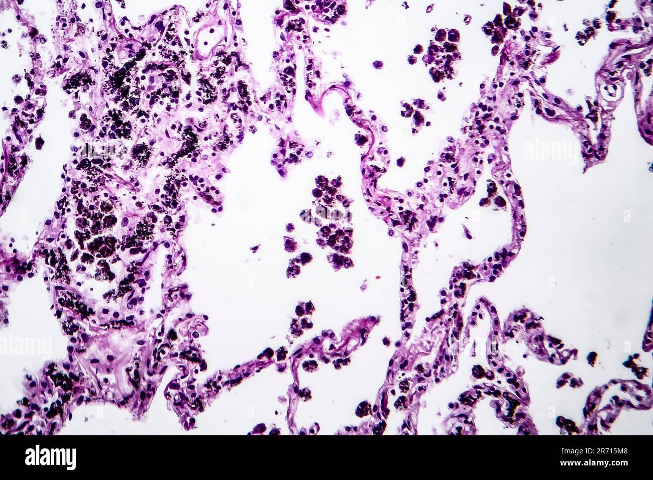 Histopathology of lung emphysema, light micrograph, photo under ...