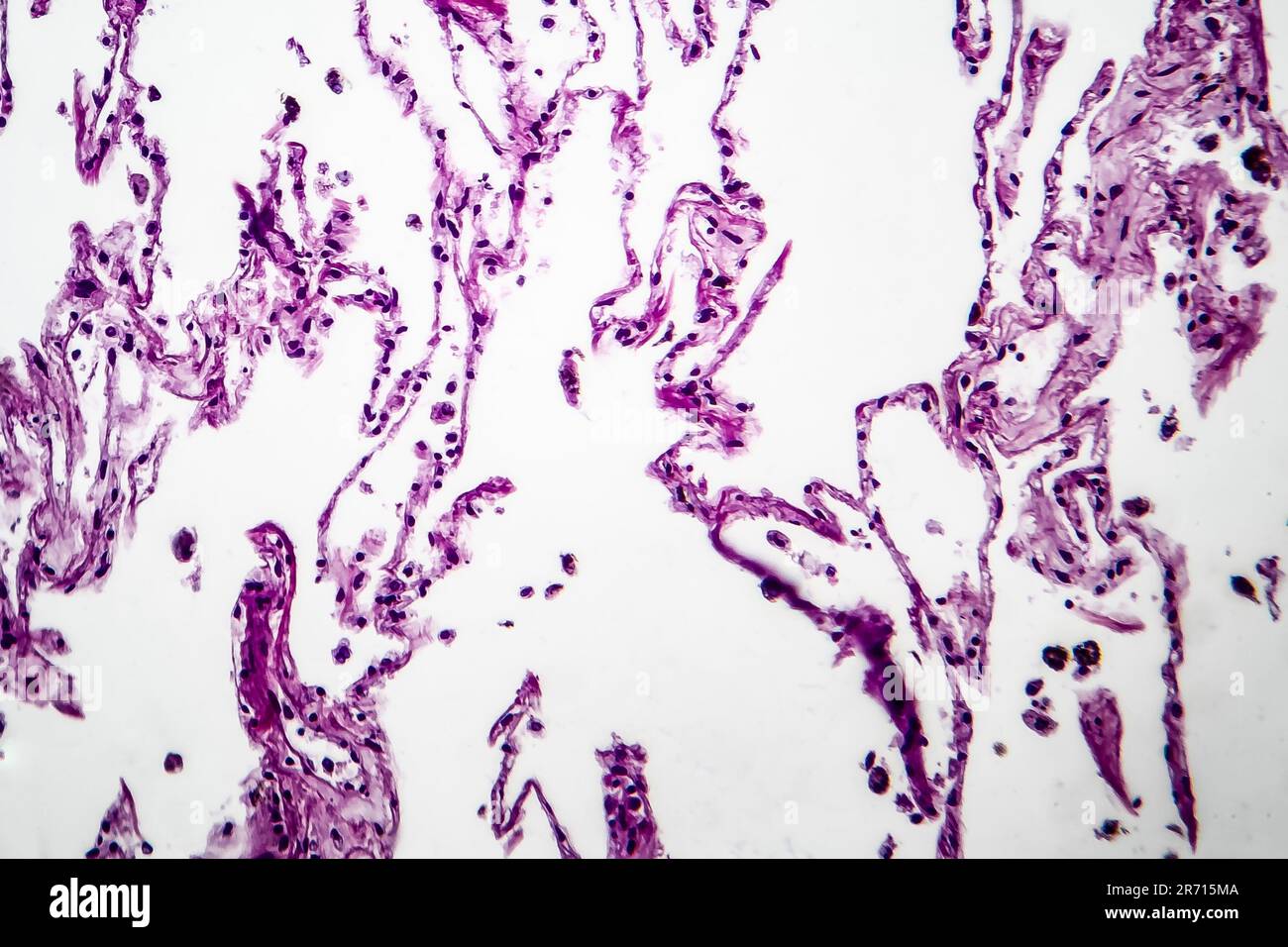 Emphysema Histology Labeled