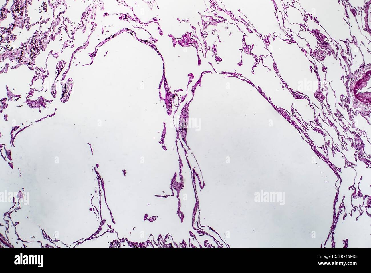 Micrograph lung alveoli alveolar hi-res stock photography and images ...