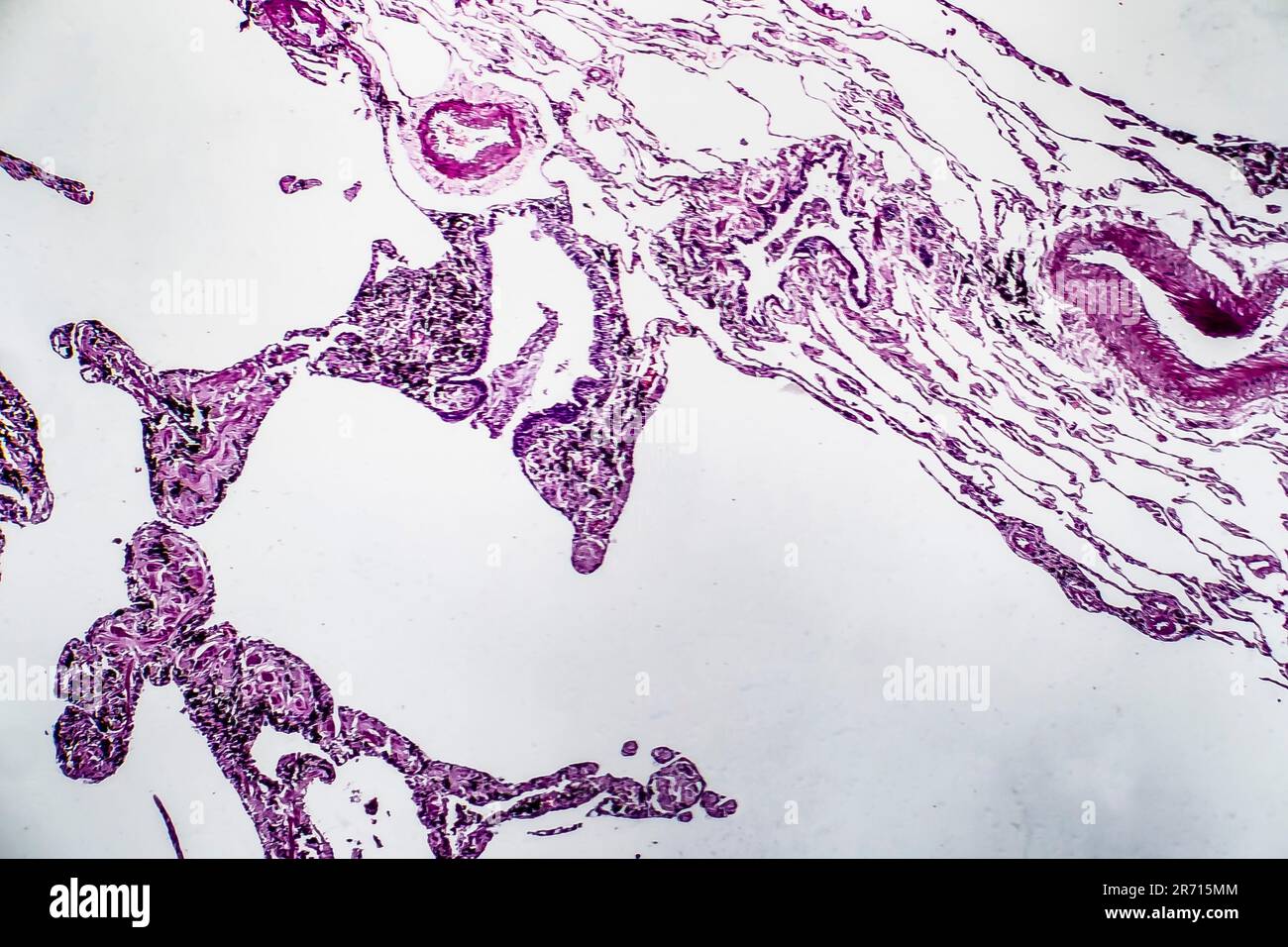 Histopathology of lung emphysema, light micrograph, photo under ...