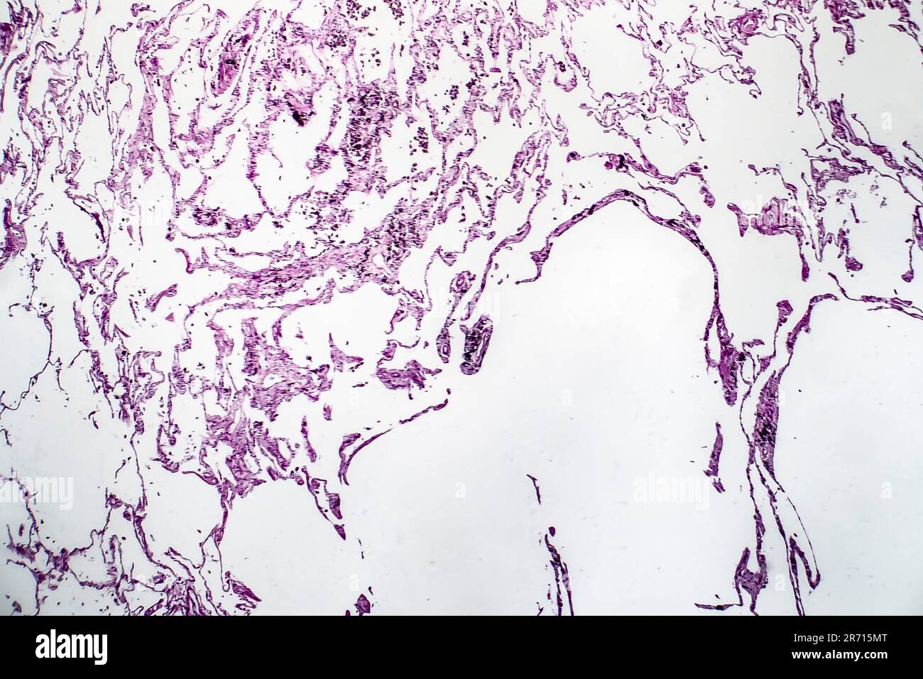 Histopathology of lung emphysema, light micrograph, photo under ...