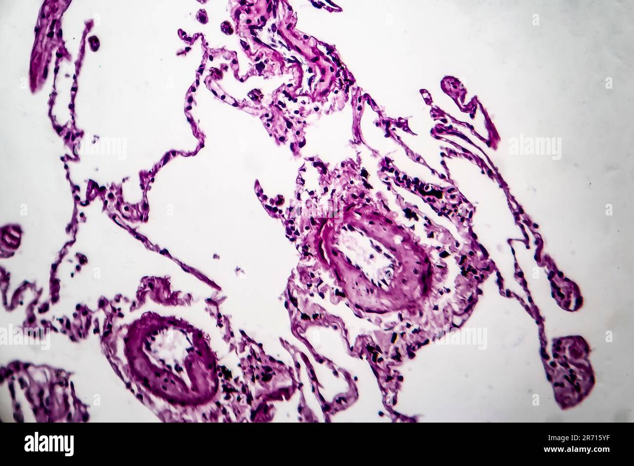 Histopathology of lung emphysema, light micrograph, photo under ...