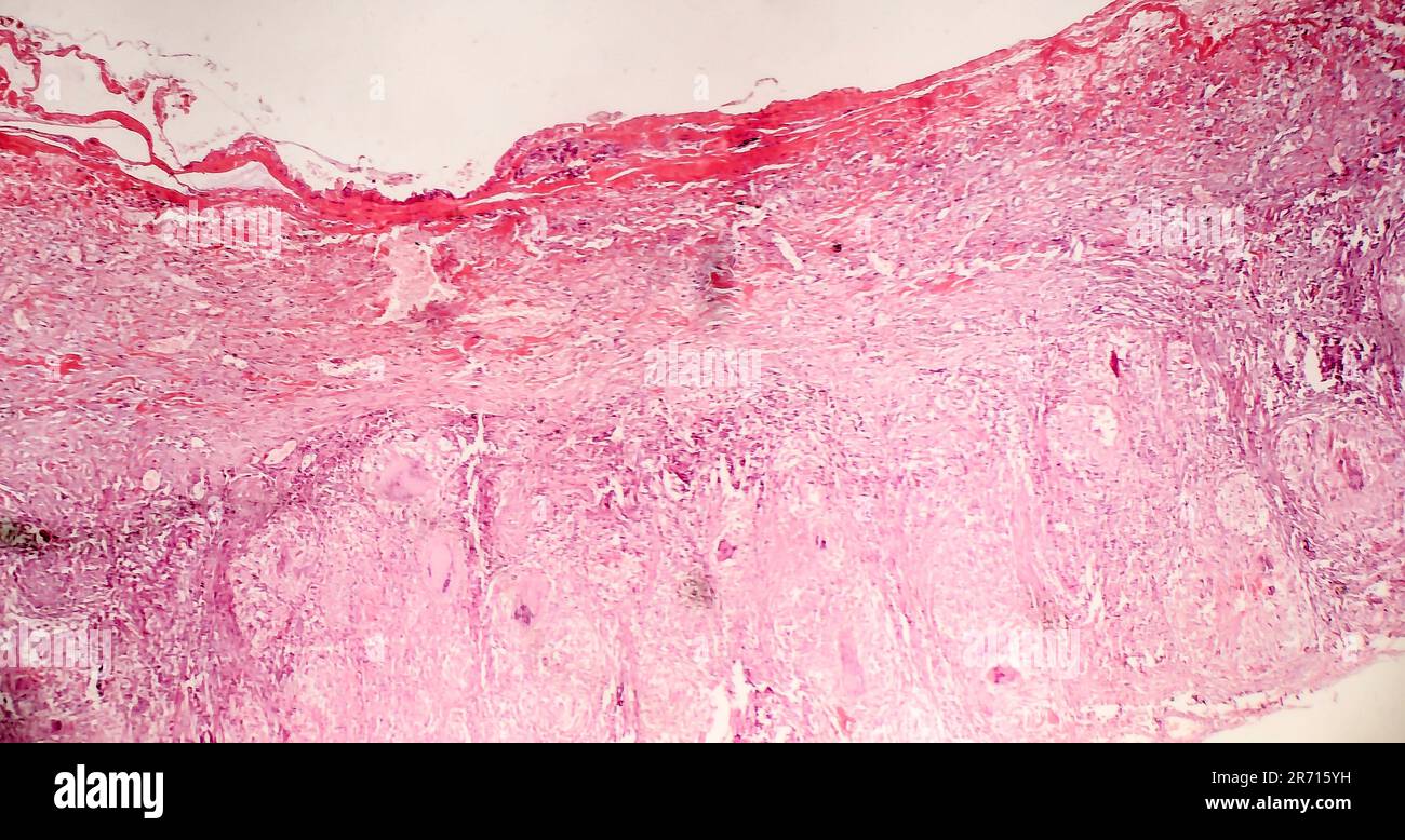 Histopathology of tuberculous pleurisy, light micrograph, photo under ...