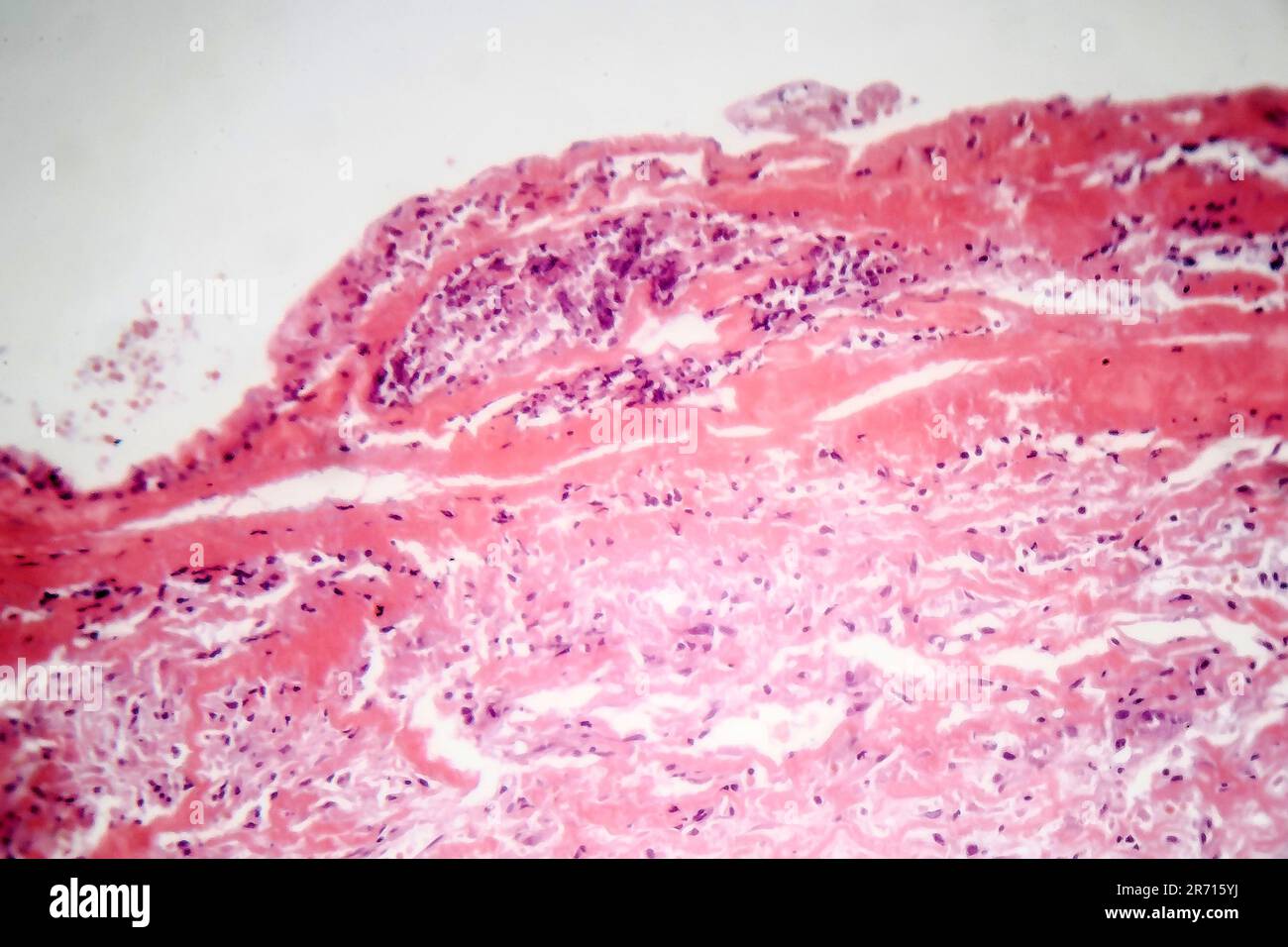 Histopathology of tuberculous pleurisy, light micrograph, photo under ...