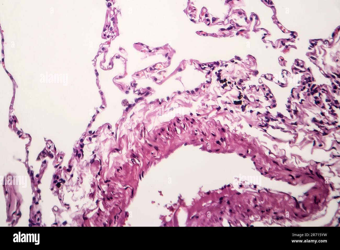 Histopathology of lung emphysema, light micrograph, photo under ...