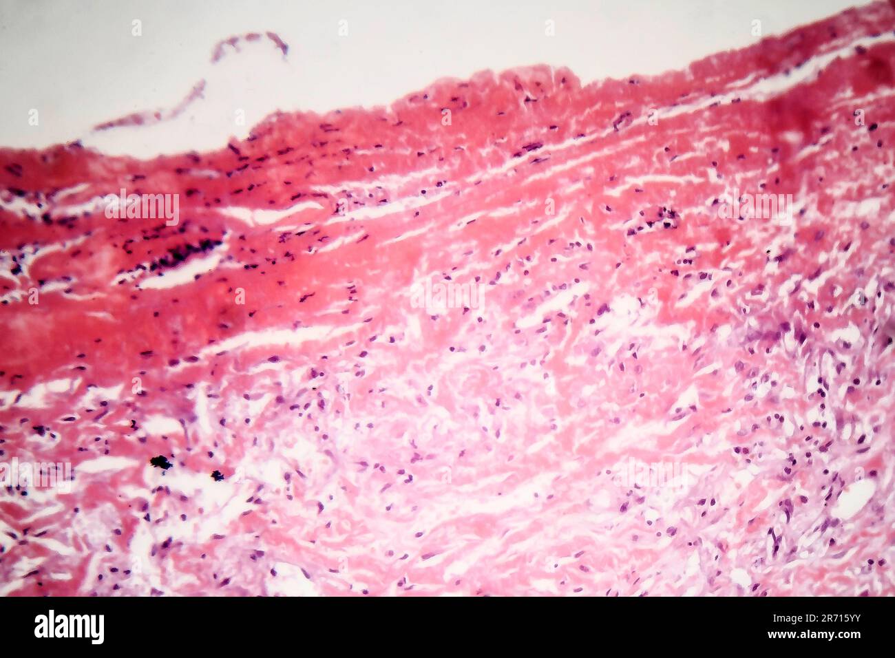 Histopathology of tuberculous pleurisy, light micrograph, photo under ...