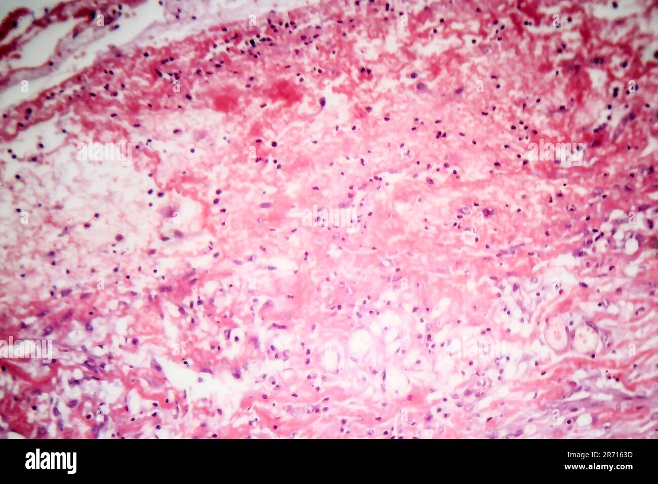 Histopathology of tuberculous pleurisy, light micrograph, photo under ...