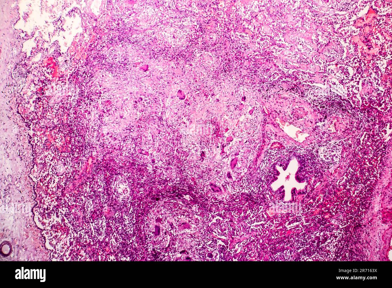 Tuberculosis tissue under microscope hi-res stock photography and ...