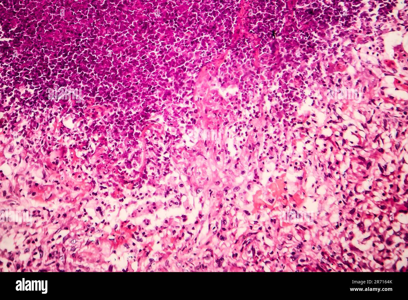 Tuberculosis tissue under microscope hi-res stock photography and ...