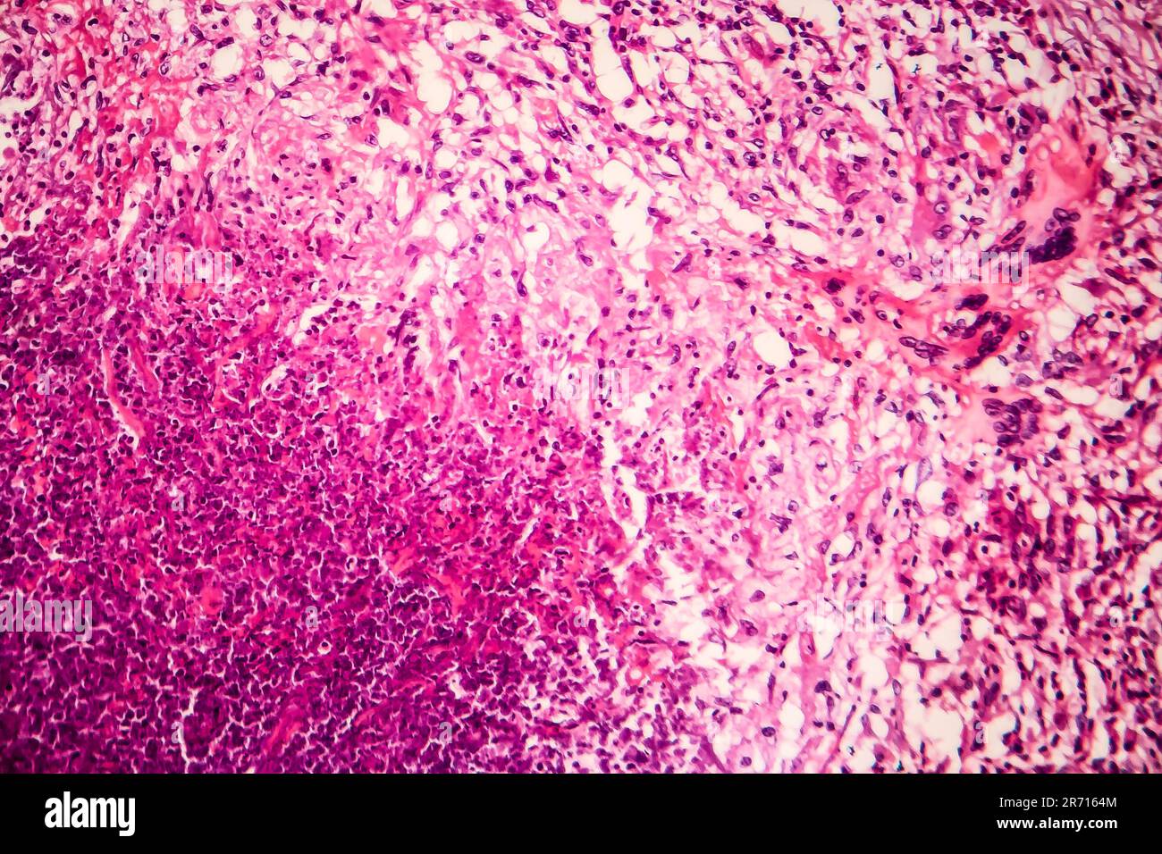 Histopathology of tubercle, light micrograph, photo under microscope ...