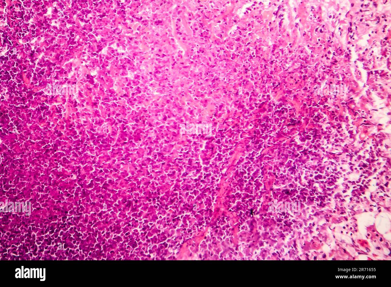Histopathology of tubercle, light micrograph, photo under microscope ...