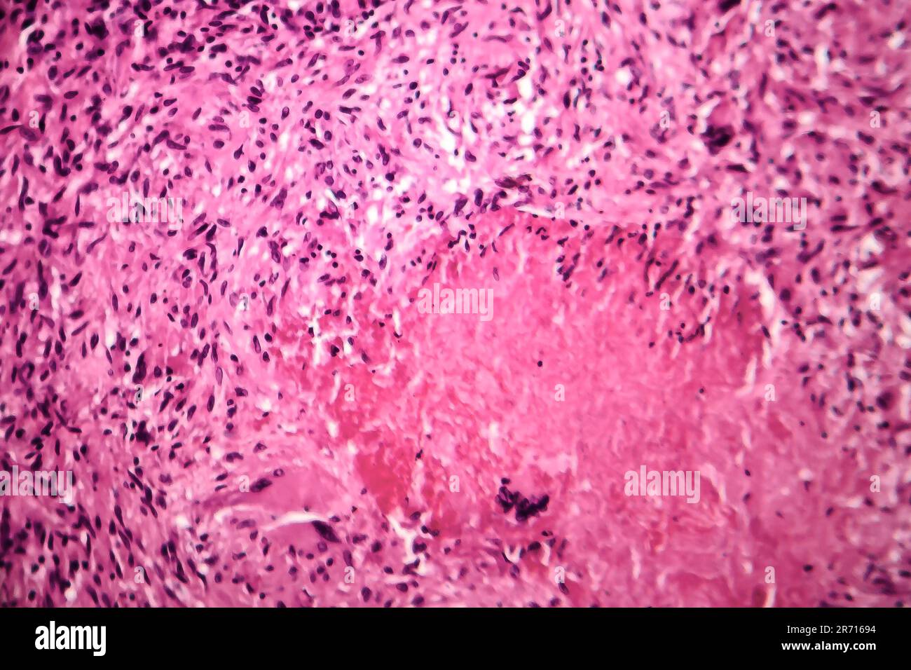 Caseous pneumonia, light micrograph, photo under microscope ...