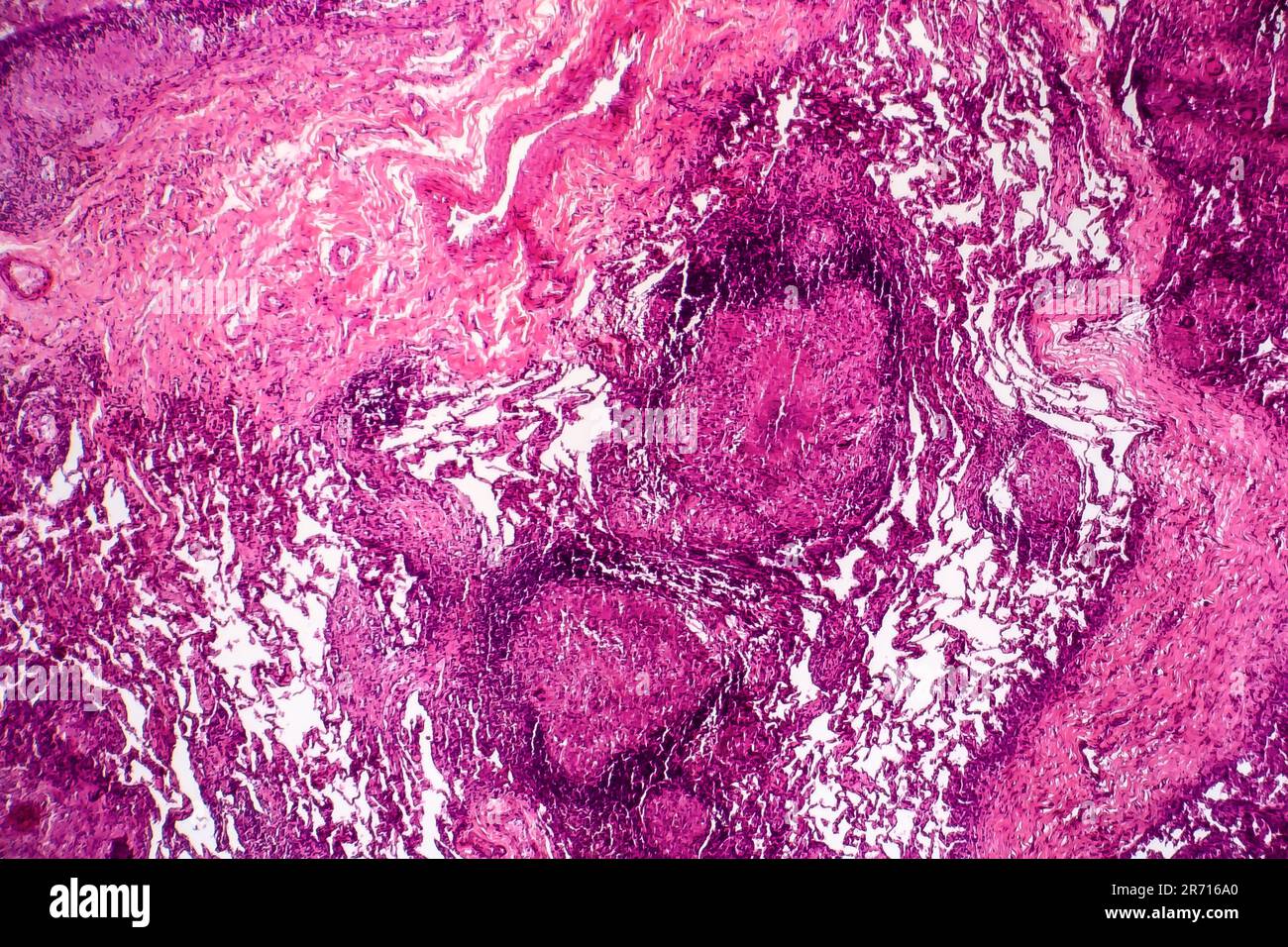 Caseous pneumonia, light micrograph, photo under microscope ...