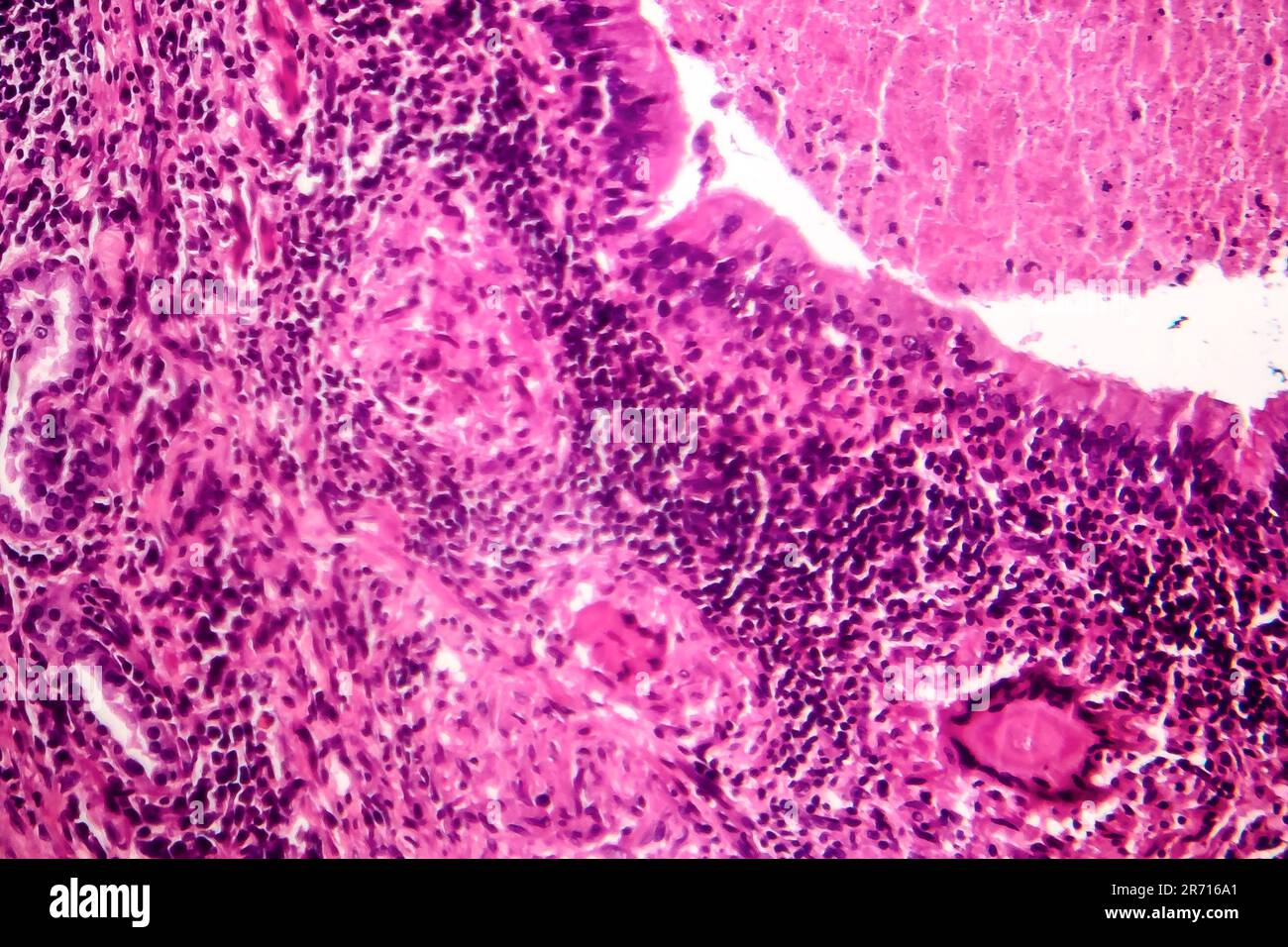 Caseous pneumonia, light micrograph, photo under microscope ...