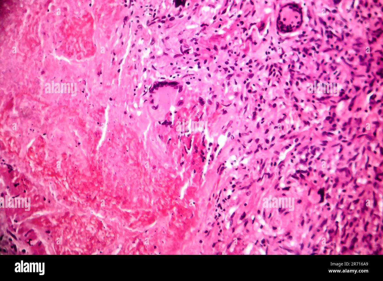 Caseous pneumonia, light micrograph, photo under microscope ...