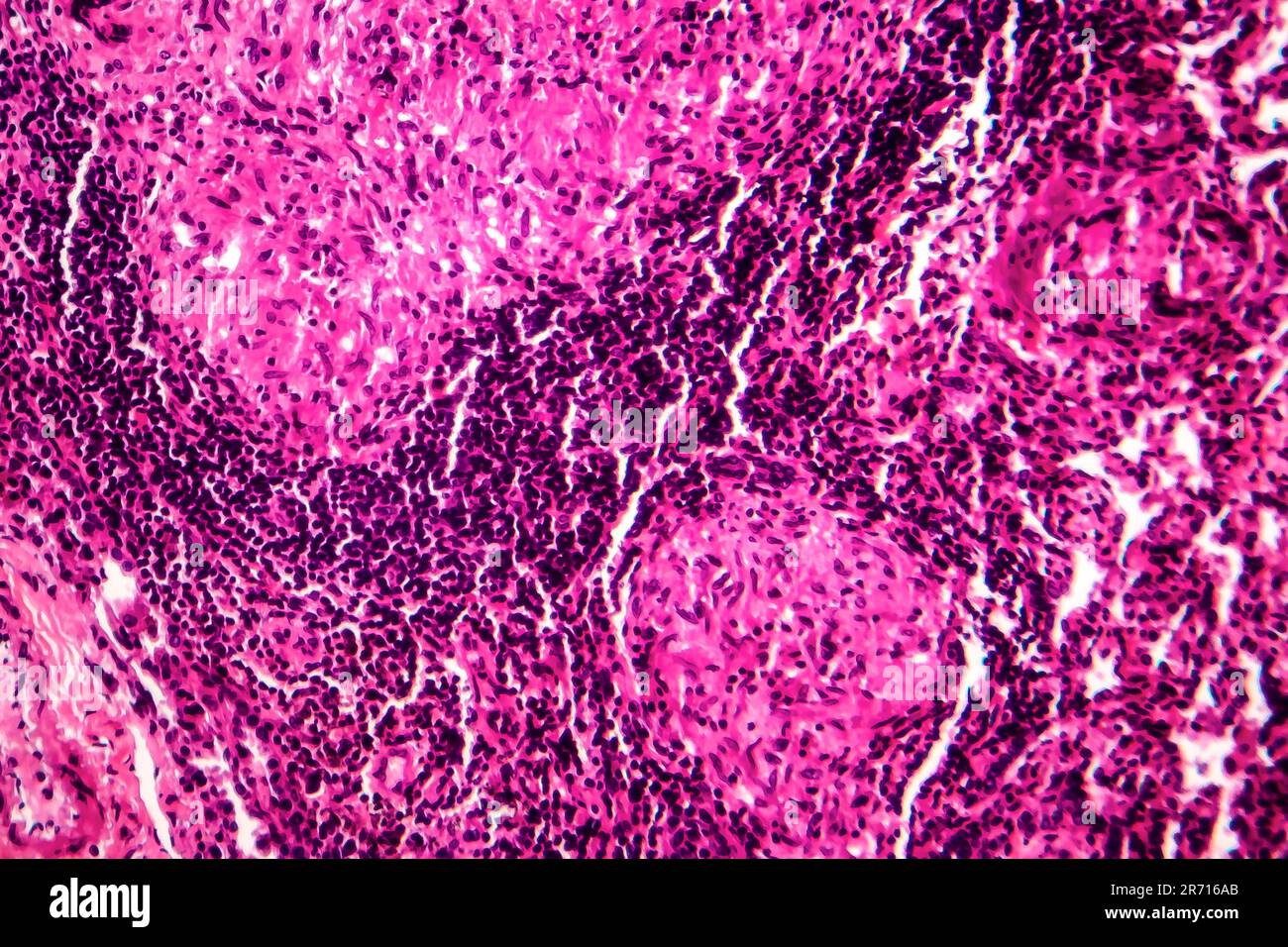 Caseous pneumonia, light micrograph, photo under microscope ...