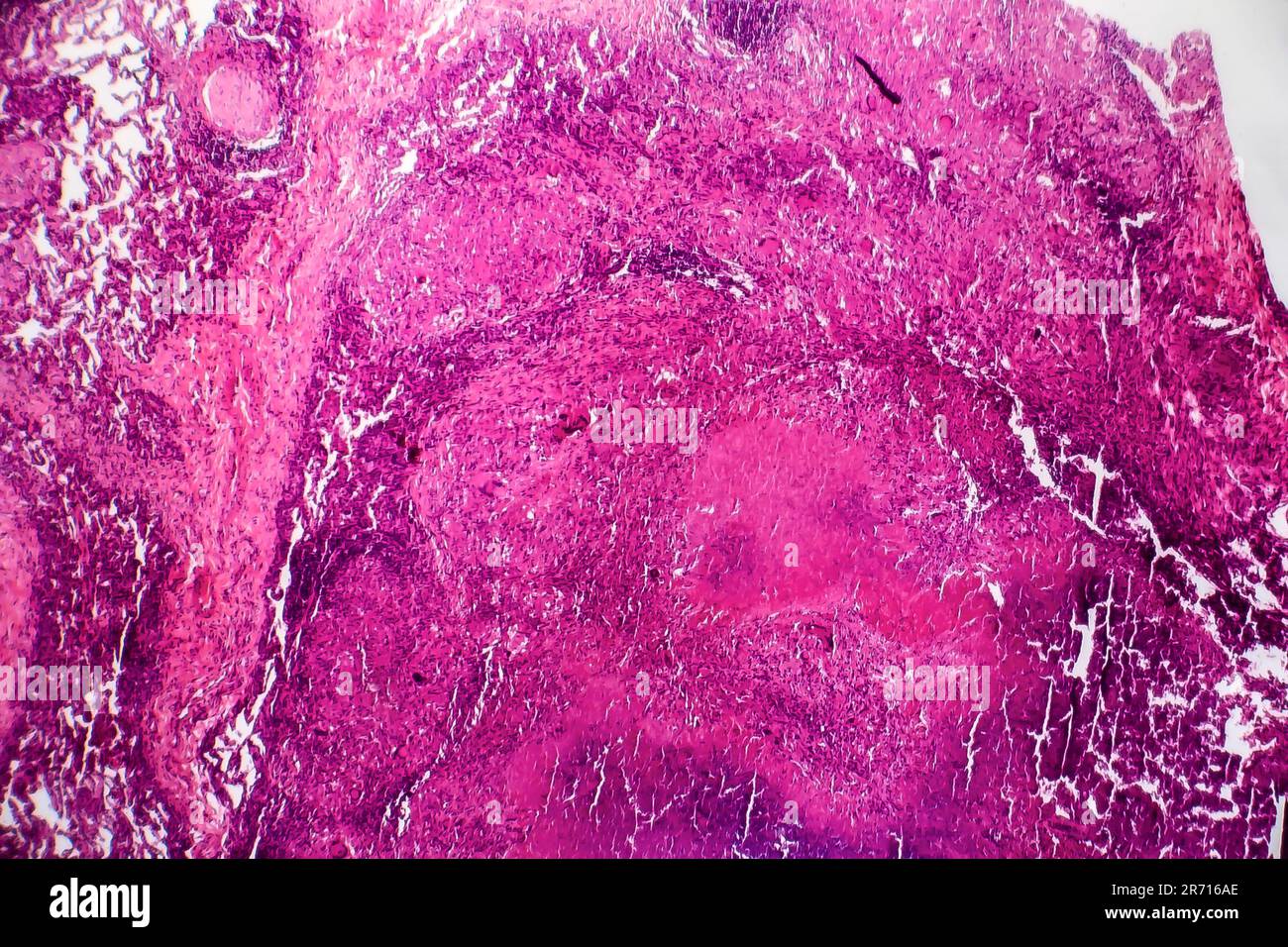 Caseous pneumonia, light micrograph, photo under microscope ...