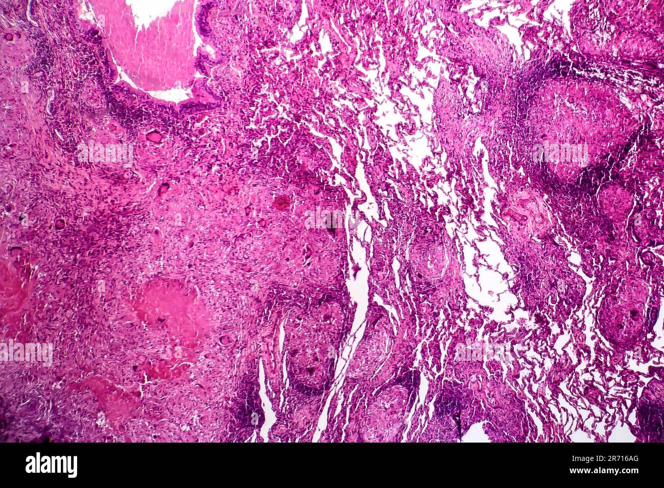 Caseous pneumonia, light micrograph, photo under microscope ...