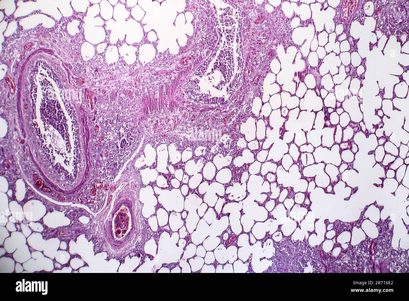 Histopathology of pneumonia, light micrograph, photo under microscope ...