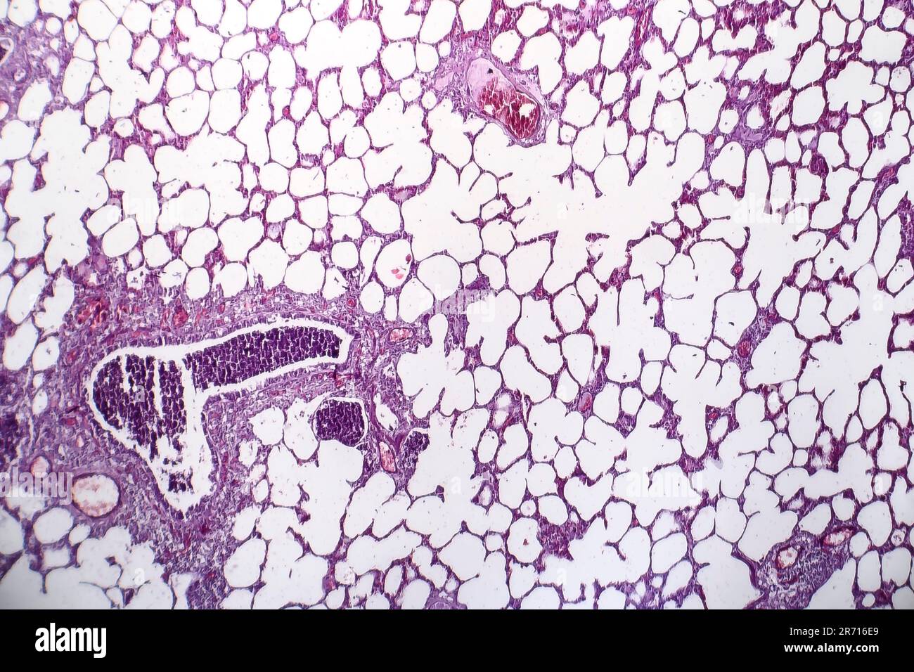 Histopathology of pneumonia, light micrograph, photo under microscope ...