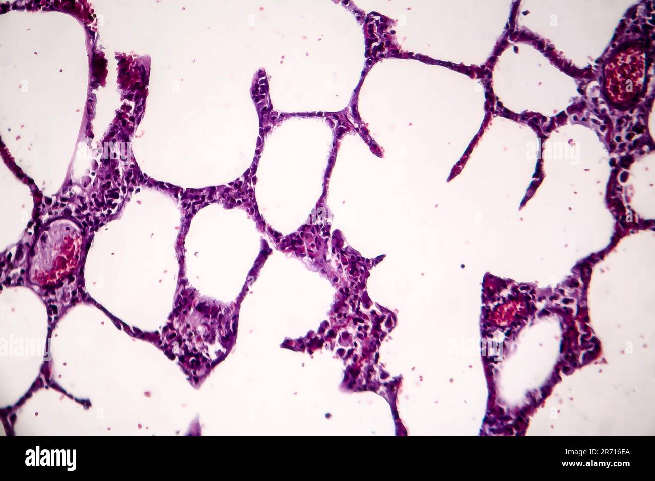 Histopathology of pneumonia, light micrograph, photo under microscope ...