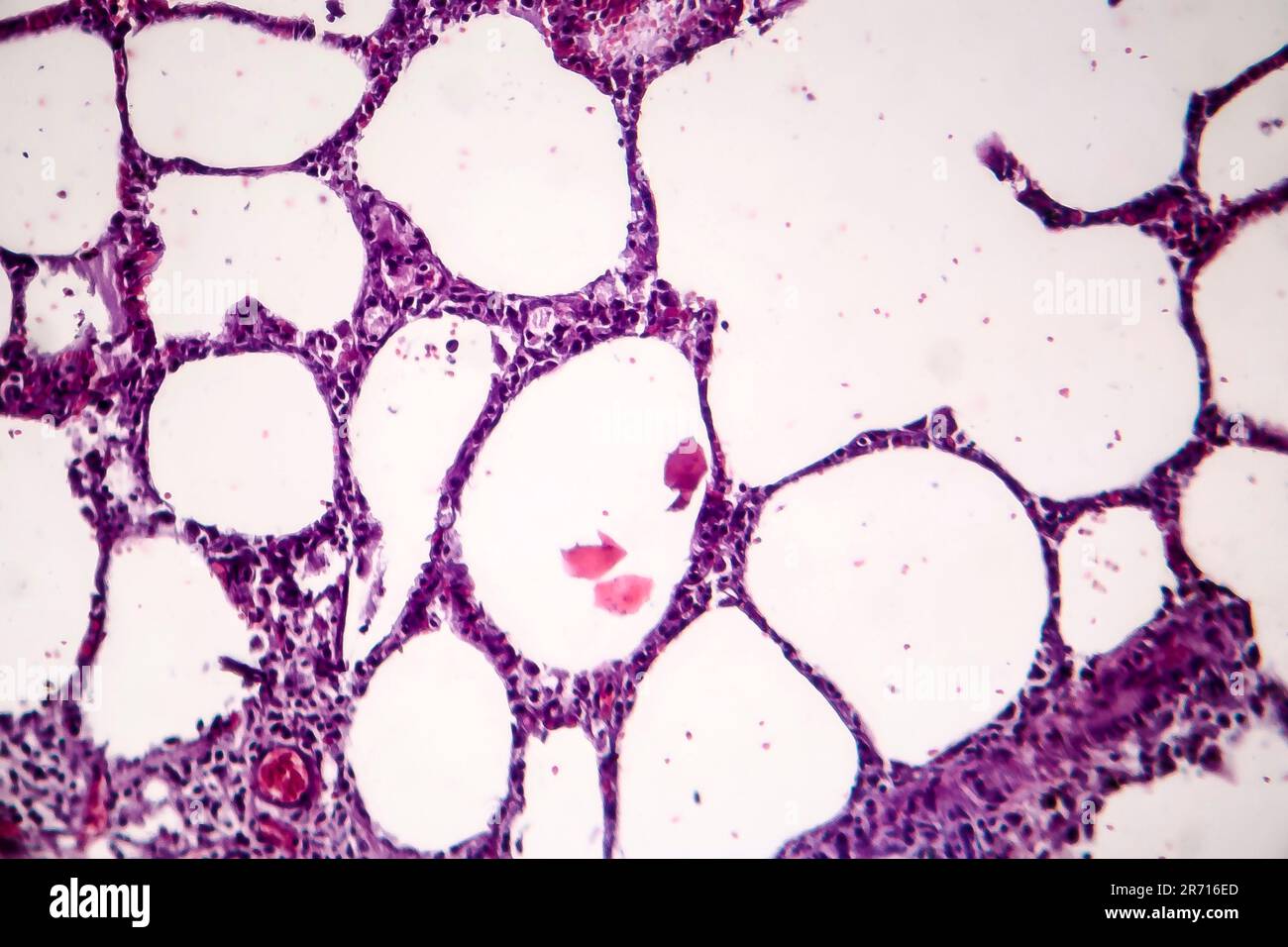 Histopathology of pneumonia, light micrograph, photo under microscope ...