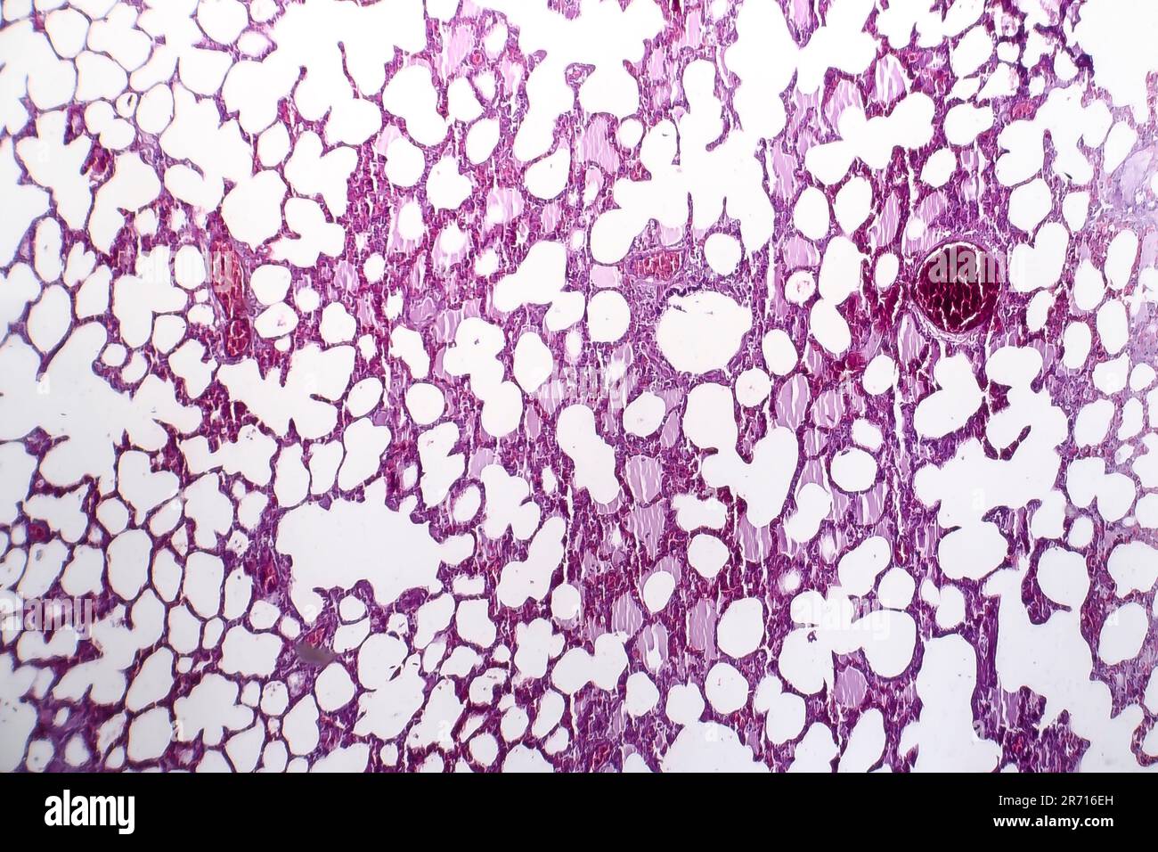 Histopathology of pneumonia, light micrograph, photo under microscope ...