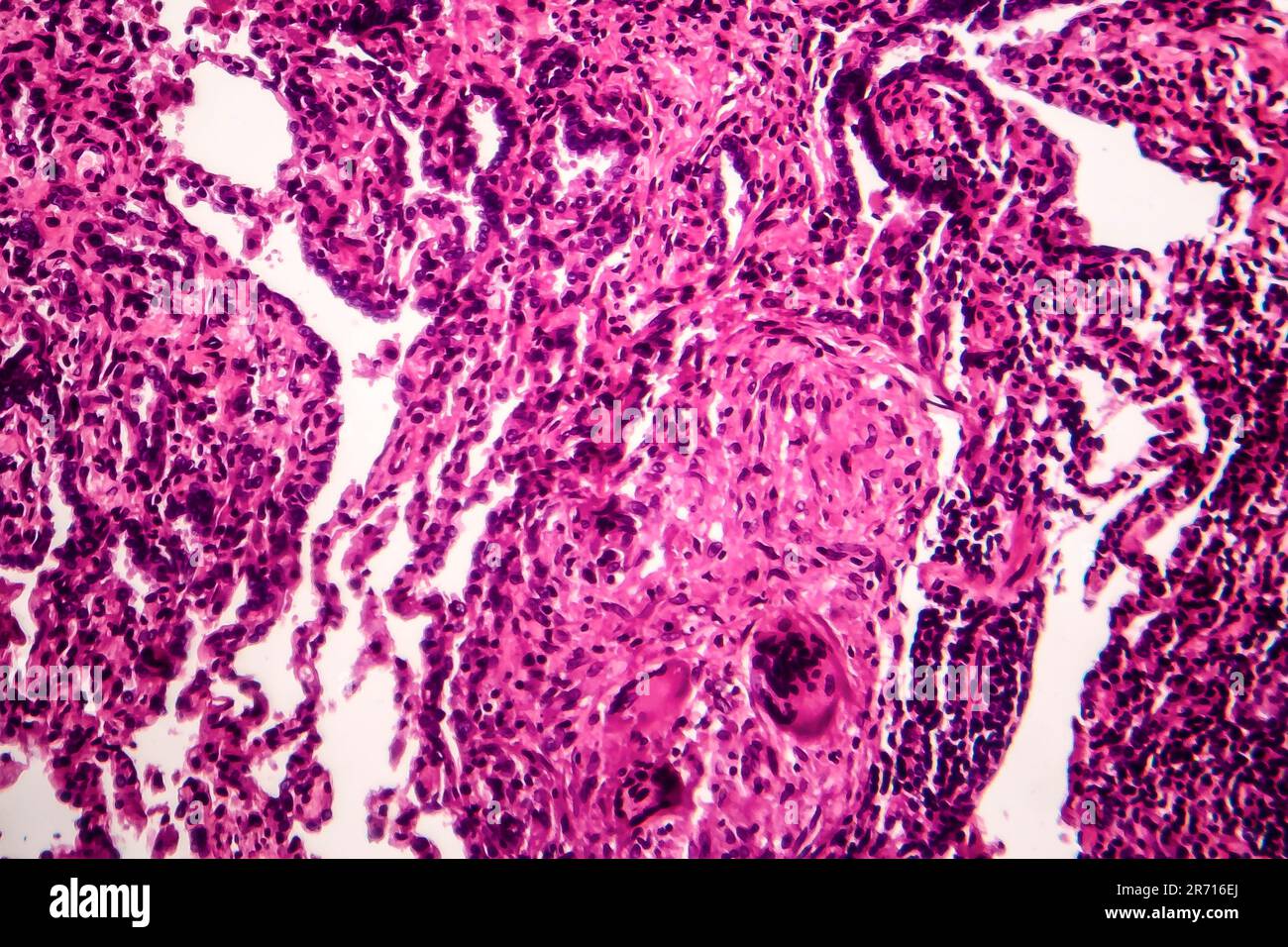 Caseous pneumonia, light micrograph, photo under microscope ...