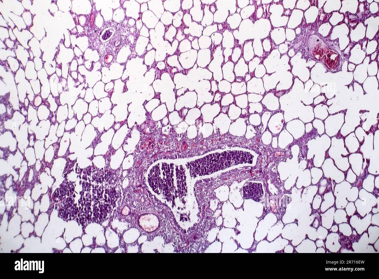 Histopathology of pneumonia, light micrograph, photo under microscope ...