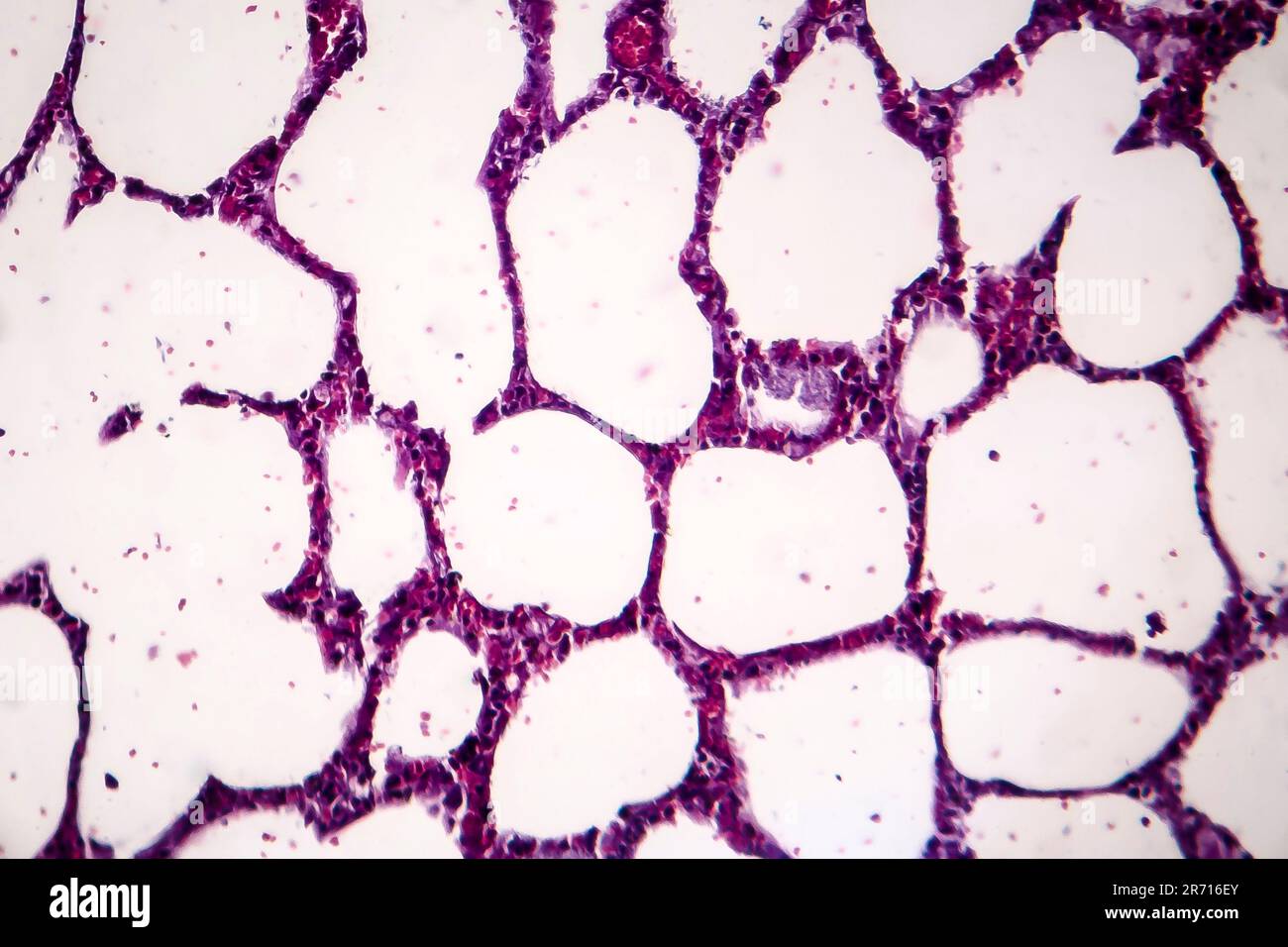 Histopathology of pneumonia, light micrograph, photo under microscope ...