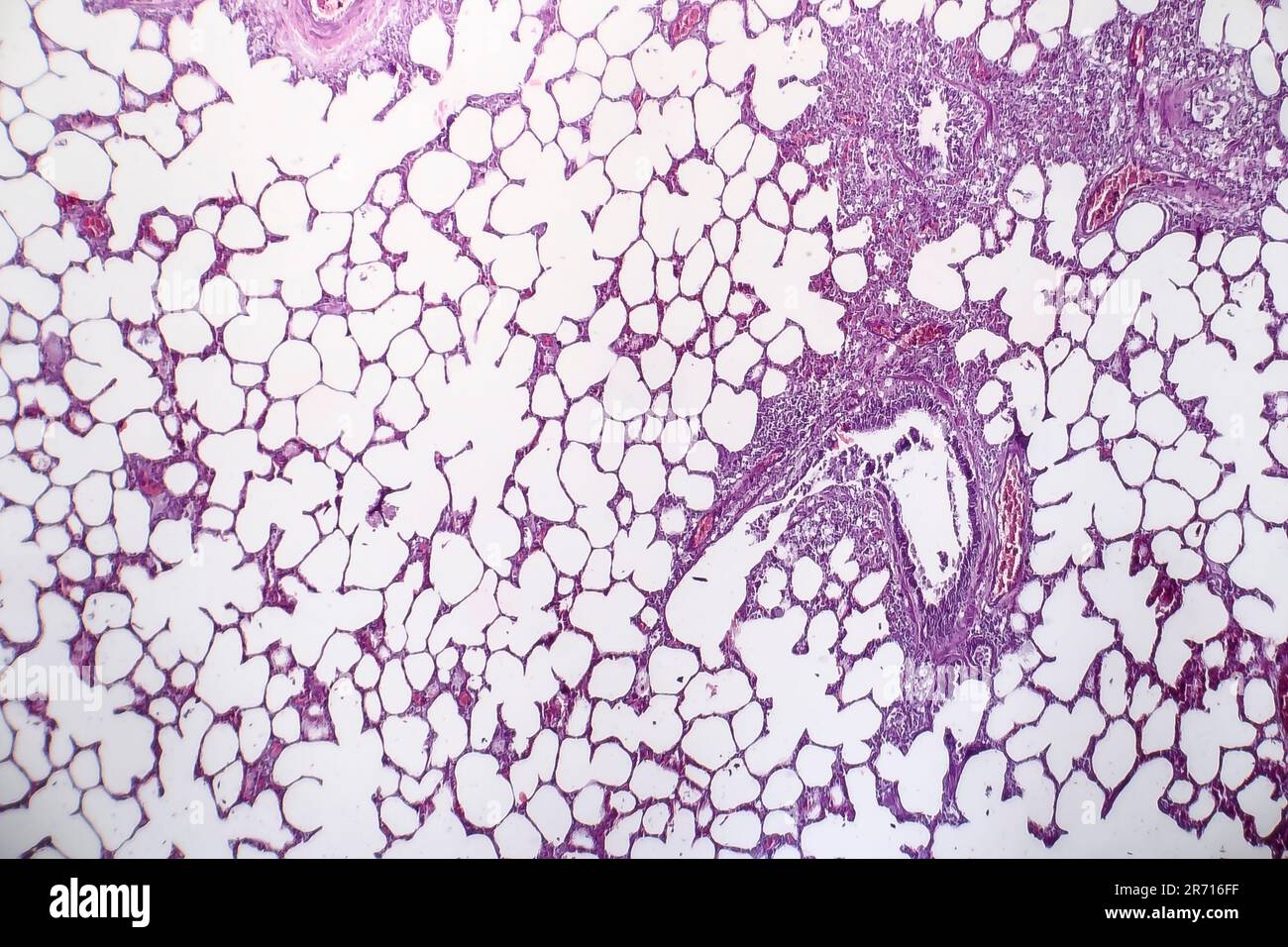 Histopathology of pneumonia, light micrograph, photo under microscope ...