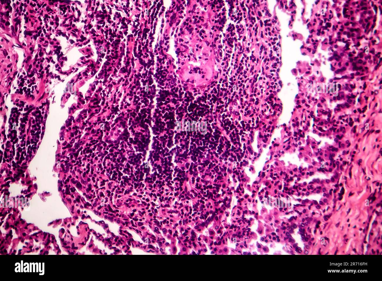 Tuberculosis tissue under microscope hi-res stock photography and ...