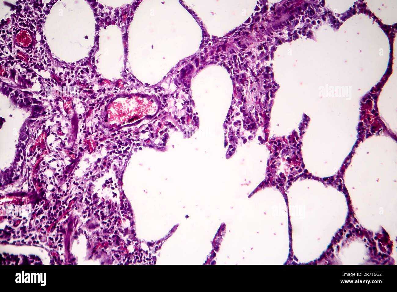 Histopathology of pneumonia, light micrograph, photo under microscope ...
