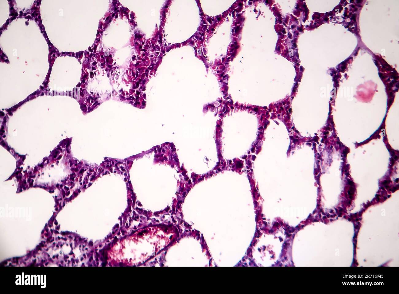 Histopathology of pneumonia, light micrograph, photo under microscope ...
