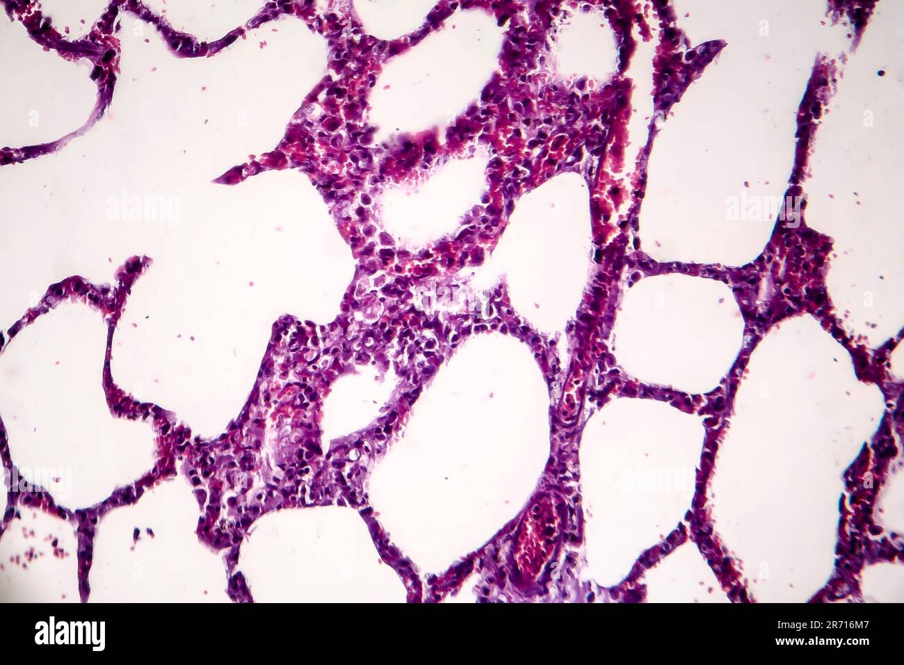 Histopathology of pneumonia, light micrograph, photo under microscope ...
